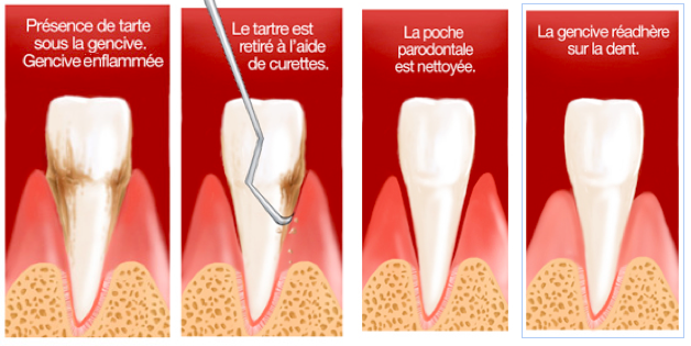 assainissement gencives