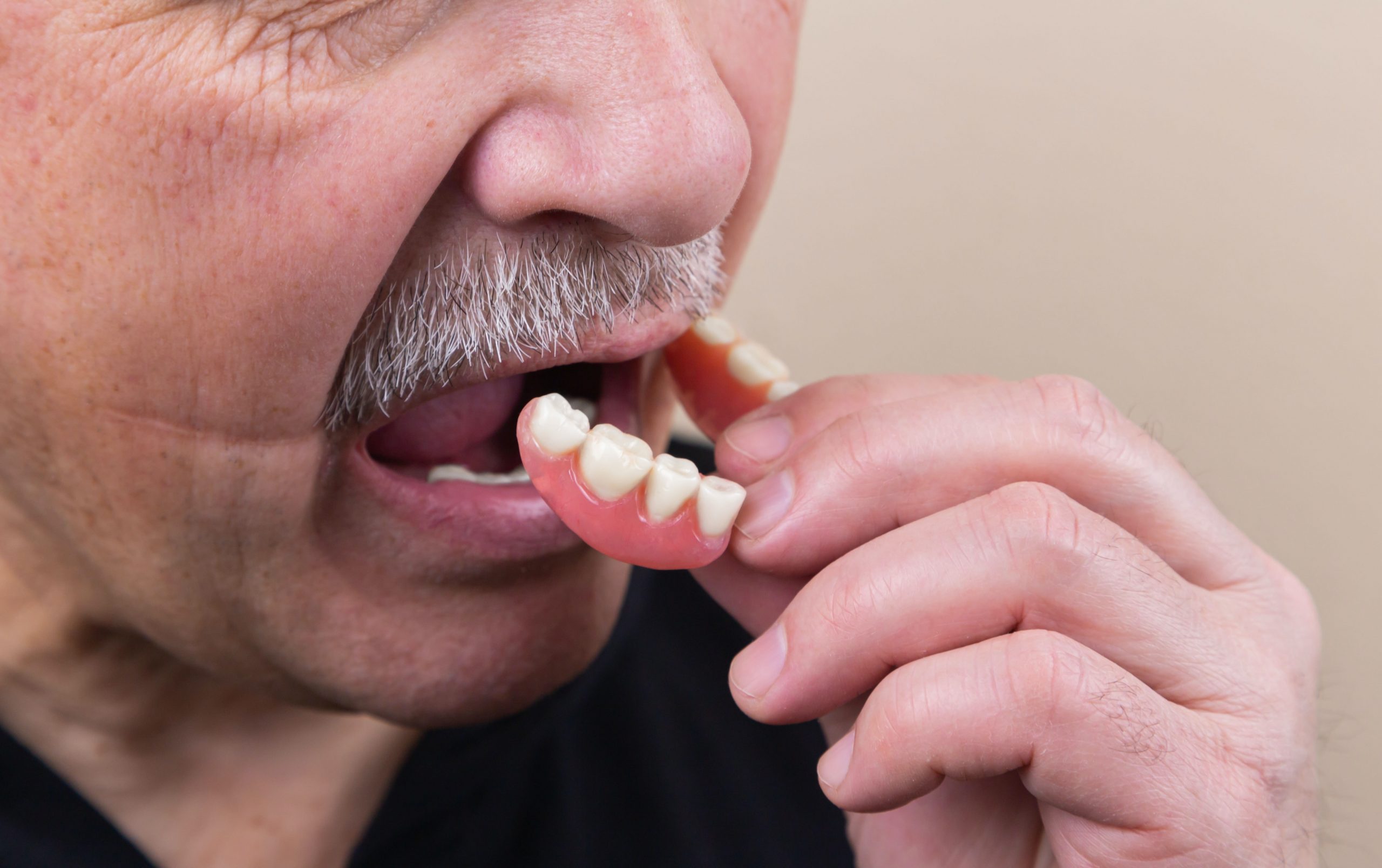 conus-transition-edentation | Dentiste La Defense